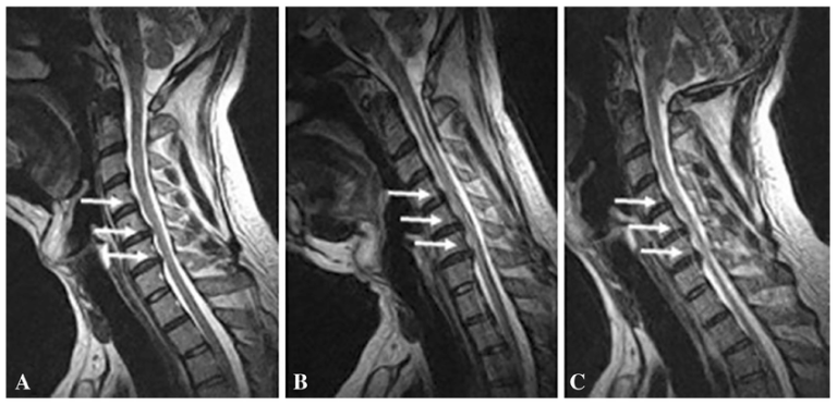 Cervical Disc Prolapse - Dr Vivek Agrawal