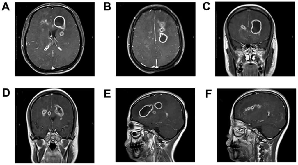 Brain Abscess - Dr Vivek Agrawal