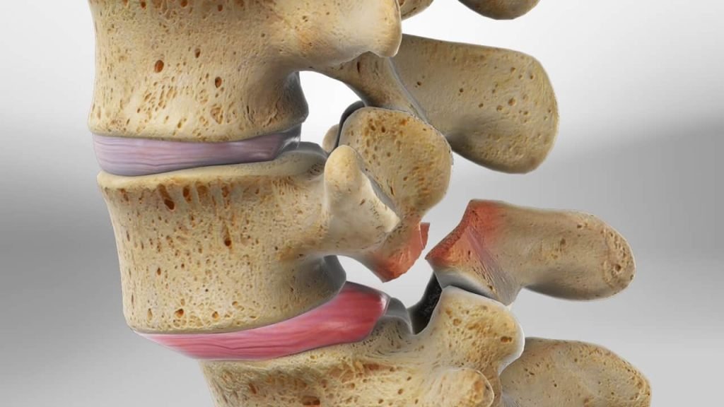 Spondylolisthesis - Dr Vivek Agrawal